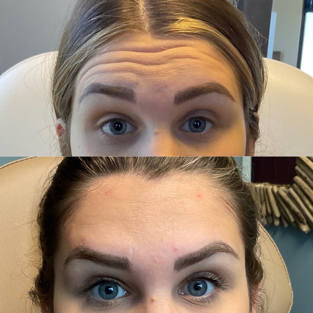 Wrinkle Releasers | BOTOX® Cosmetic | Naperville IL